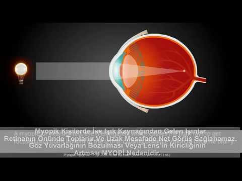Myopi Nedir? Elif Optik Aliağa