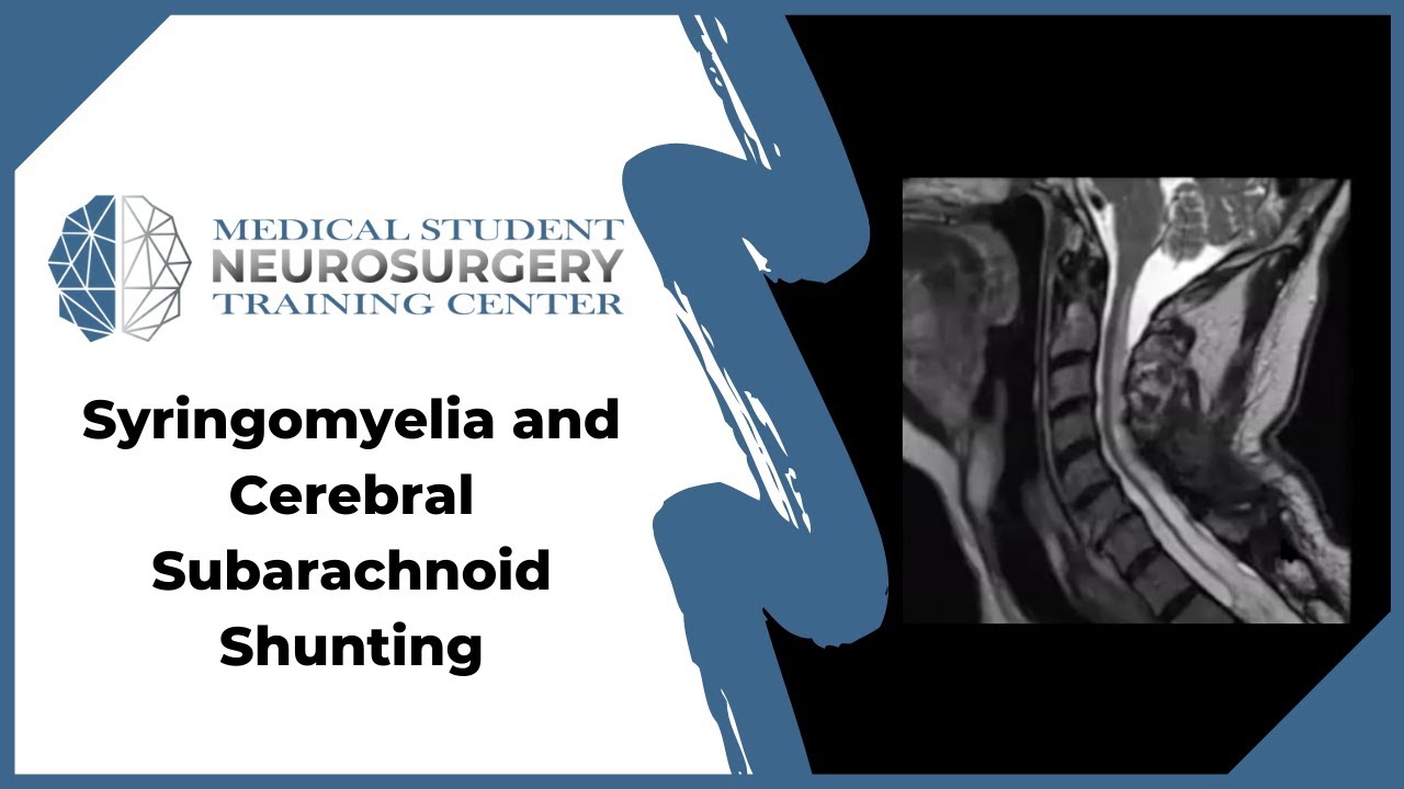 Syringomyelia and Cerebral Subarachnoid Shunting - YouTube