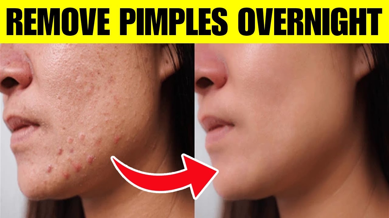 8 Best Home Remedies For Pimples And Dark Spots How To Get Rid Of 8-best-home-remedies-for-pimples-and-dark-spots-how-to-get-rid-of