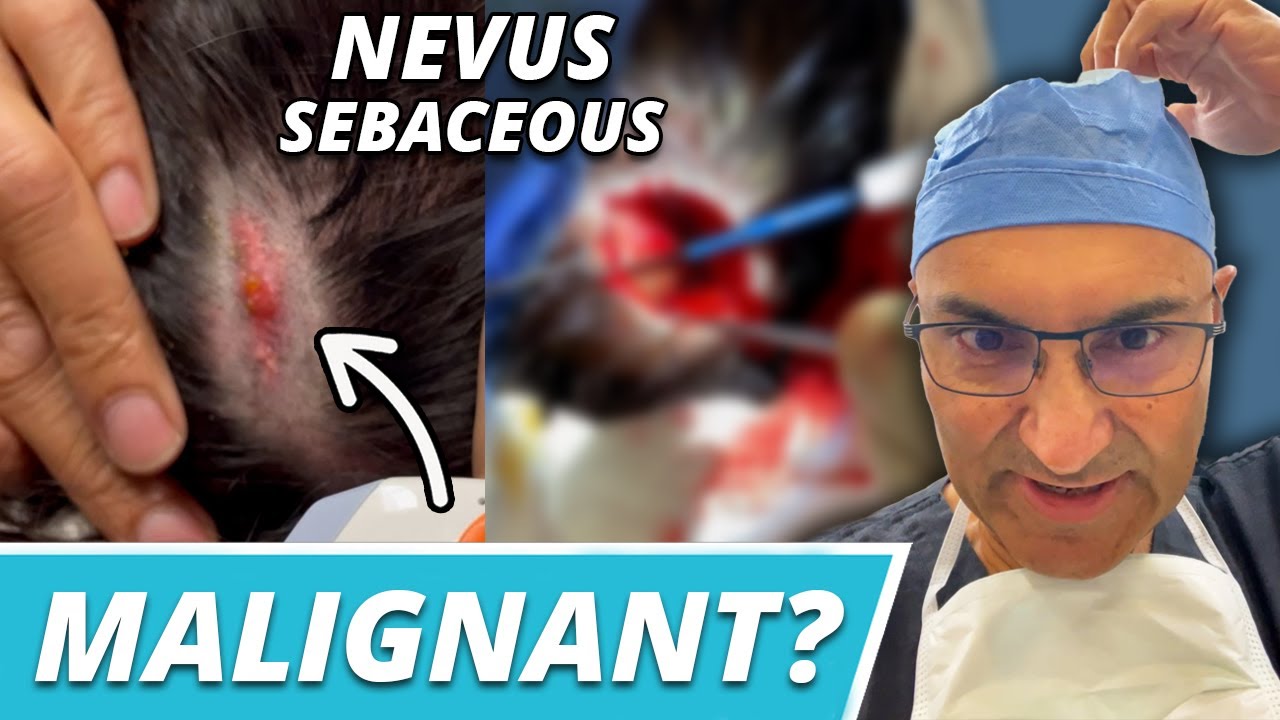 Surgery for a strange scalp spot? Dr. Janjua removes a nevus sebaceous ...
