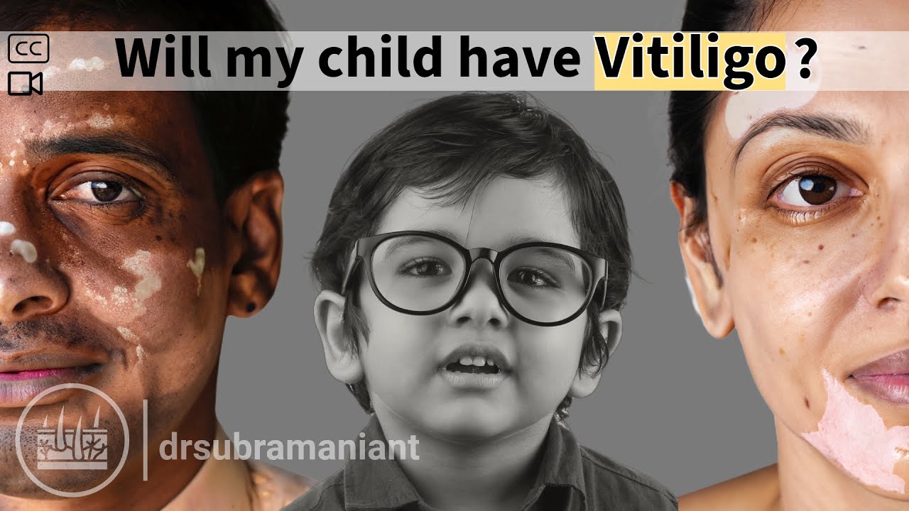 Every parent with vitiligo must know! - YouTube
