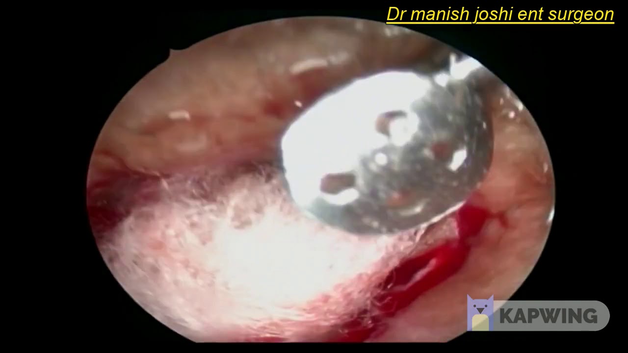 Endoscopic tympanoplasty (double perforation in tympanic membrane ...