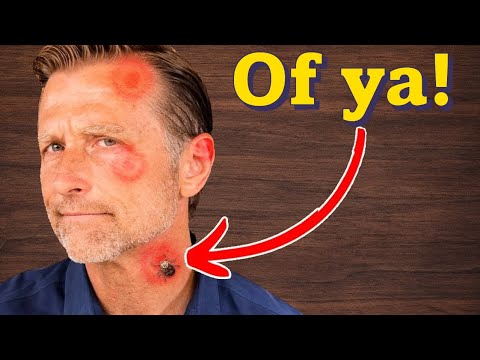 Her hafta 20 kene ısırığı alıyorum (Lyme Hastalığı) | Dr. Berg Türkçe