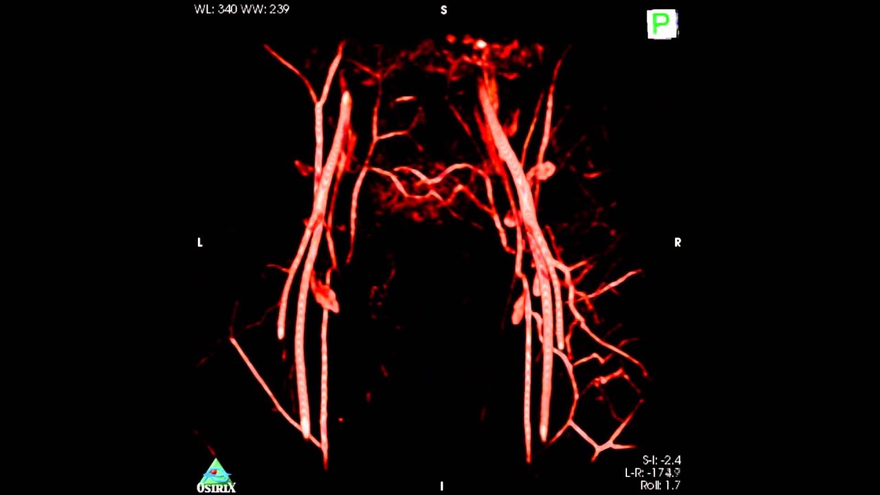 Pelvis MRA based on 3D T1 FSPGR at 1.5T - YouTube