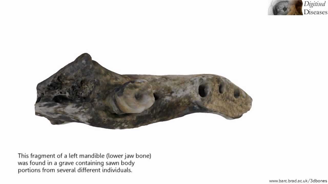 A sawn jaw bone from the London Hospital - YouTube
