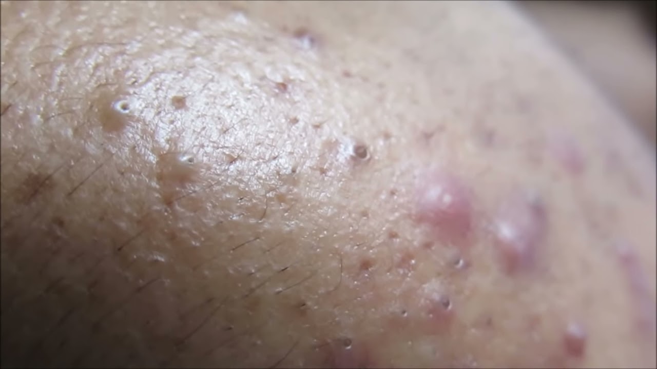 After A Long Time Comedone Extraction Video - YouTube