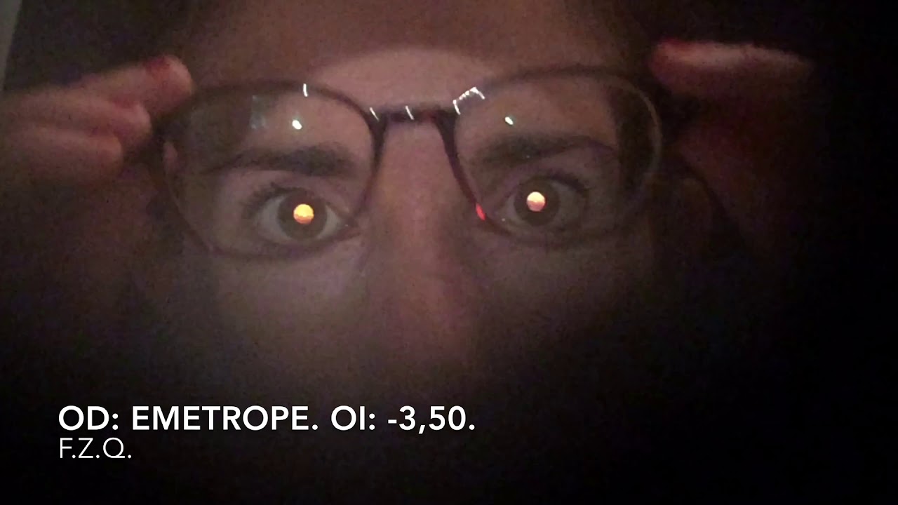 Test de Bruckner en anisometropías con y sin compensación. - YouTube