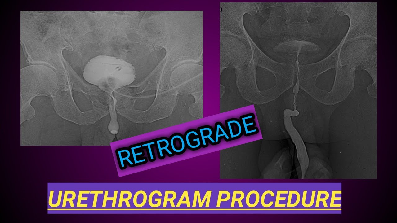 Retrograde Urethrogram Procedure | X ray Urethrogam | Urine Blockage ...