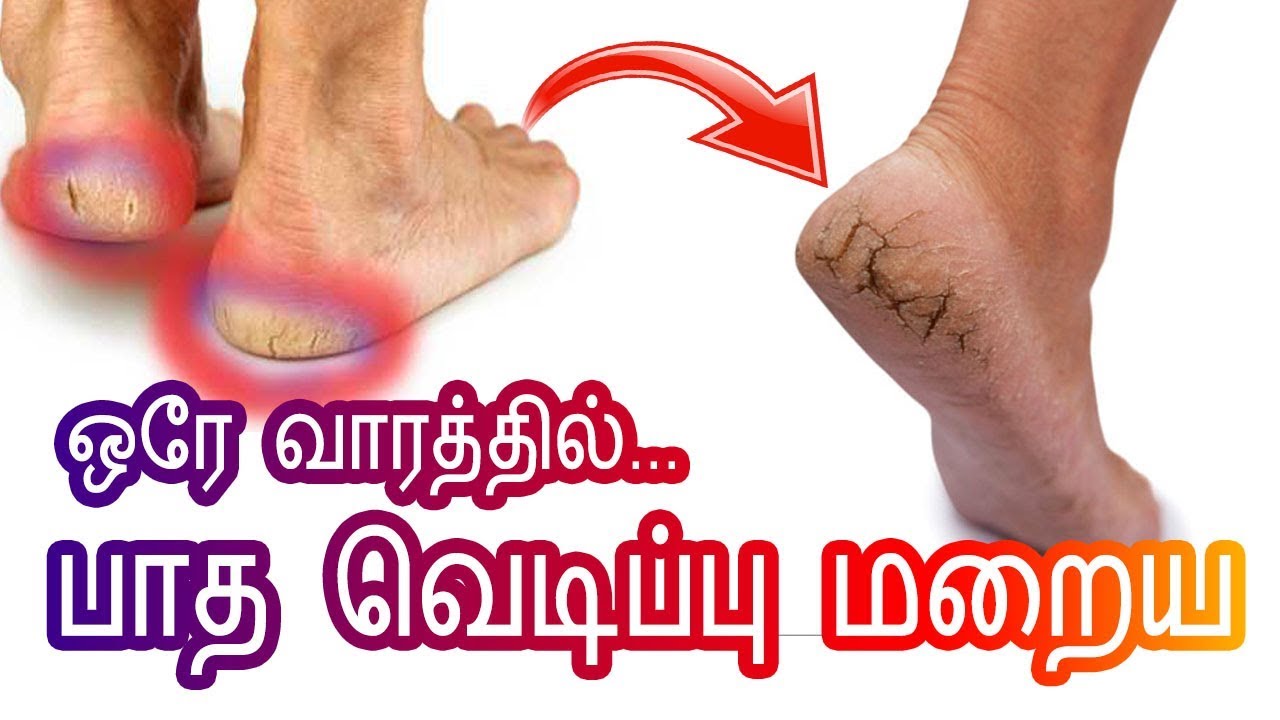 Remove Cracked Feet Heel In Tamil Foot Crack Tamil remove-cracked-feet-heel-in-tamil-foot-crack-tamil