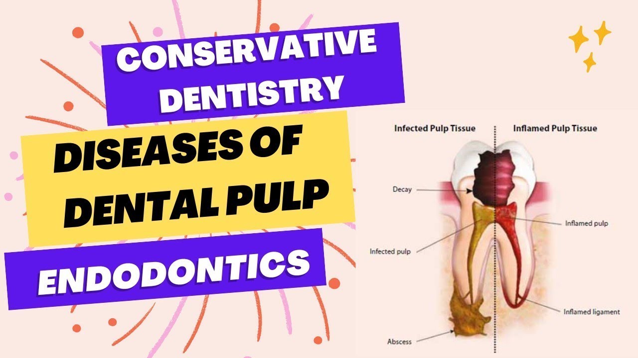 ADC part 1 exam . A simple way to diagnose pulpal diseases - YouTube
