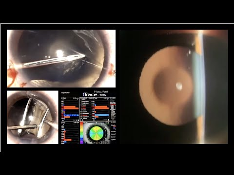 Phaco in a patient with Anterior Lenticonus - proper investigations and ...