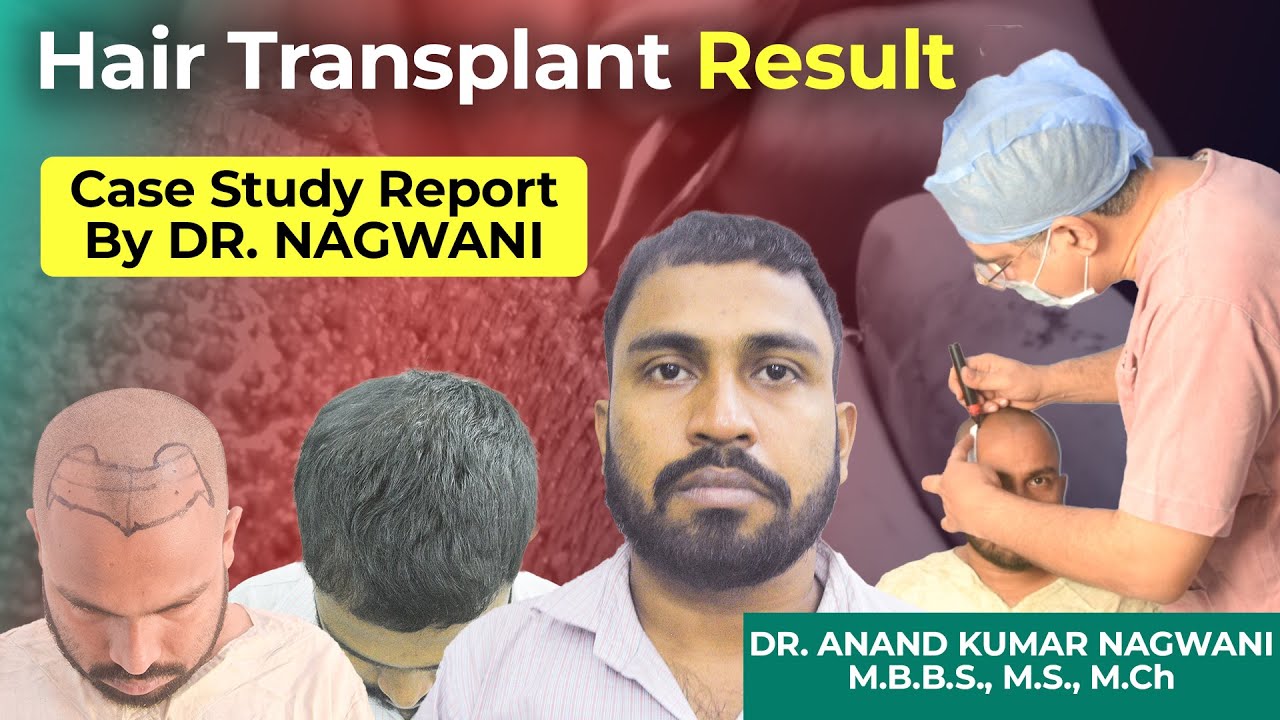 FUT Hair Transplant Results | 6-Month Progress by Dr. Anand Kumar Nagwani | Calcutta Cosmo Aid ...