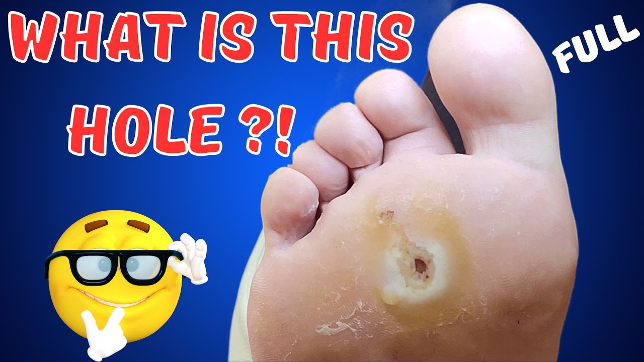 Strange hole in the sole. - YouTube