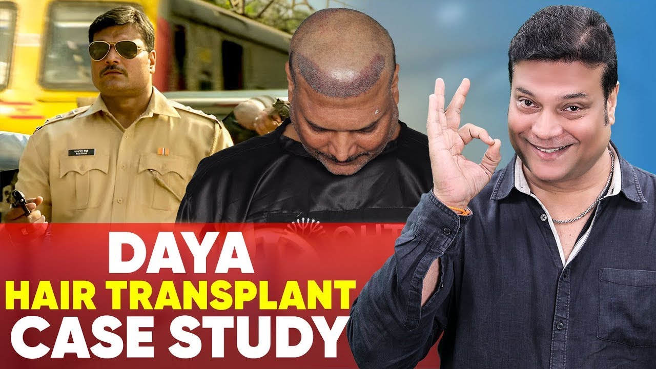 Bollywood Actor DAYA Got Hair Transplant with Best Results - YouTube