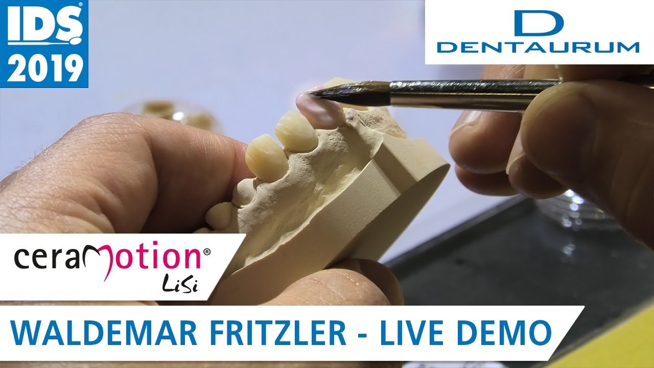 ceraMotion® LiSi auf der IDS 2019: Frontzahn-Veneers - YouTube