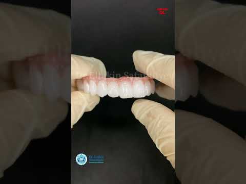 İmplantüstü zirkon dişlər