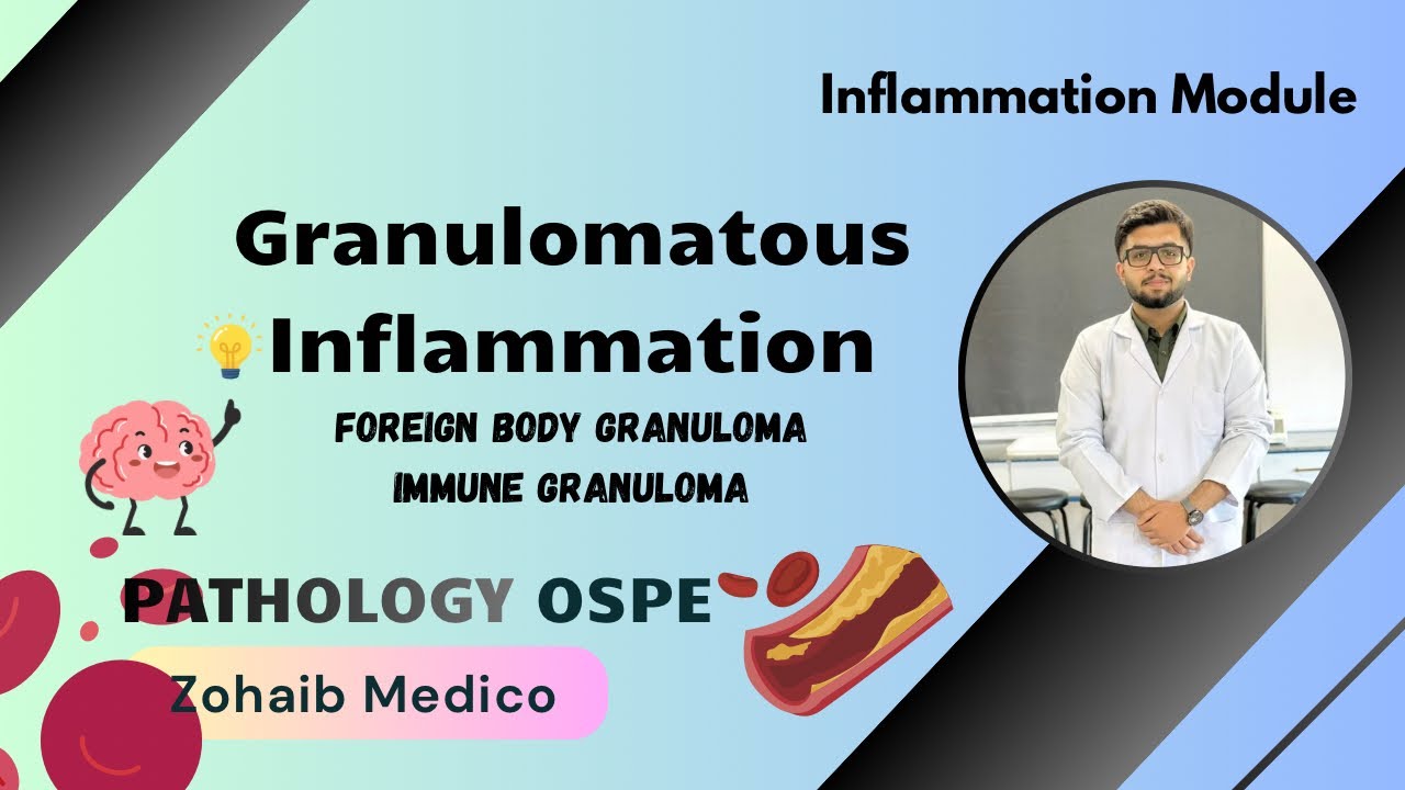 Granulomatous Inflammation | Types, examples and OSPE questions ...