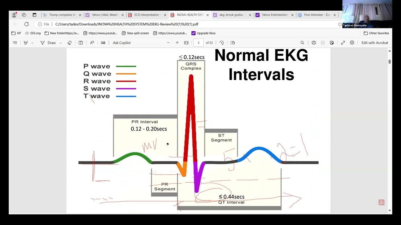 EKG Analysis & Interpretation - YouTube