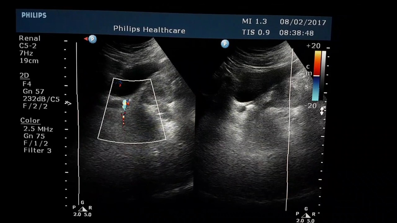 VUJ Calculus + Twincle Artifact Ultrasound - YouTube