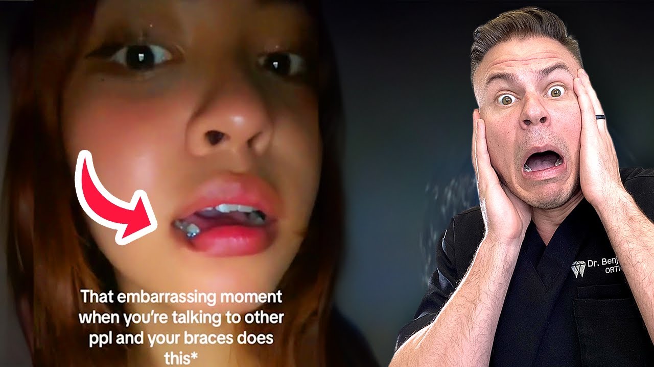 How Your Braces Hooks Can Cause Big DAMAGE To Your Mouth! - YouTube