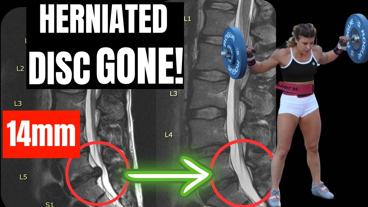 14mm L5-S1 Disc Herniation ELIMINATED to 0mm (Sciatica + Back Pain 100% ...
