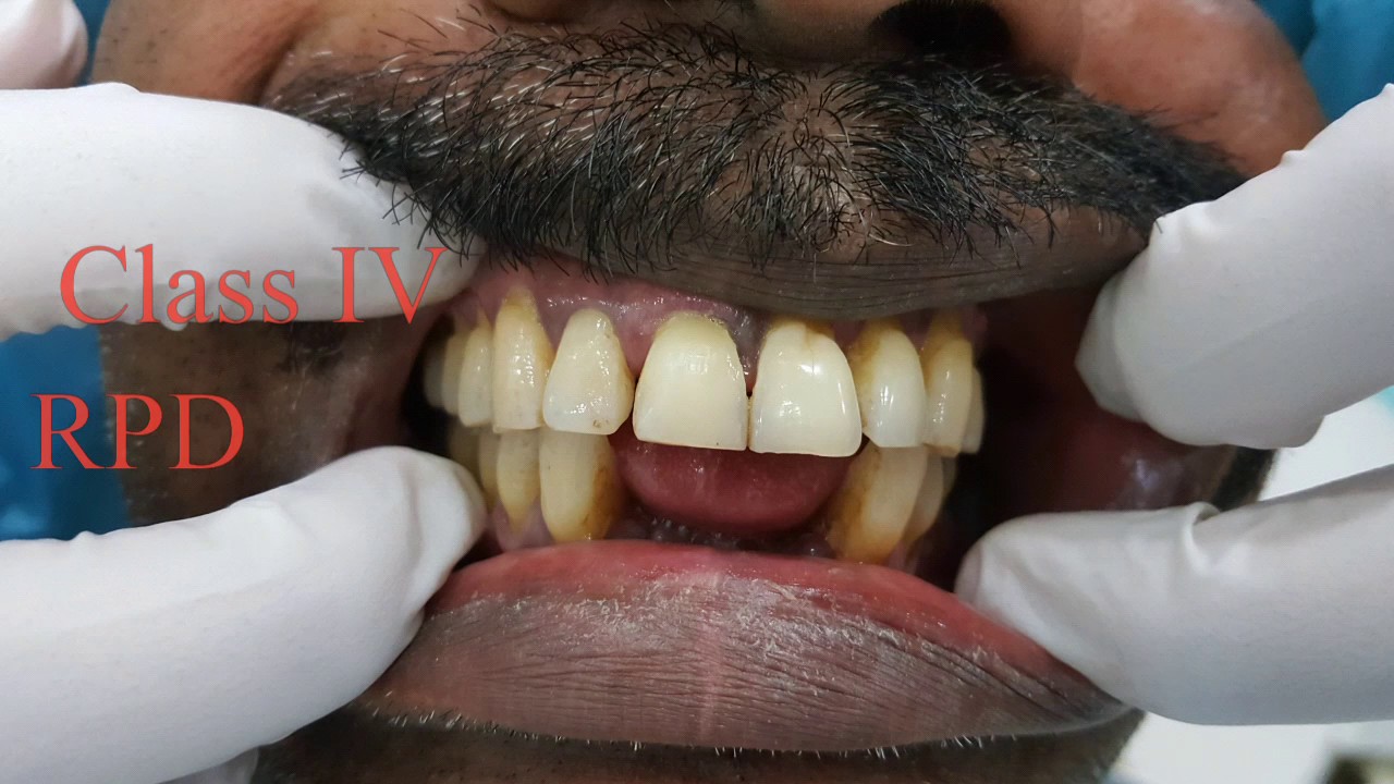 Class IV RPD AUST dental student - YouTube