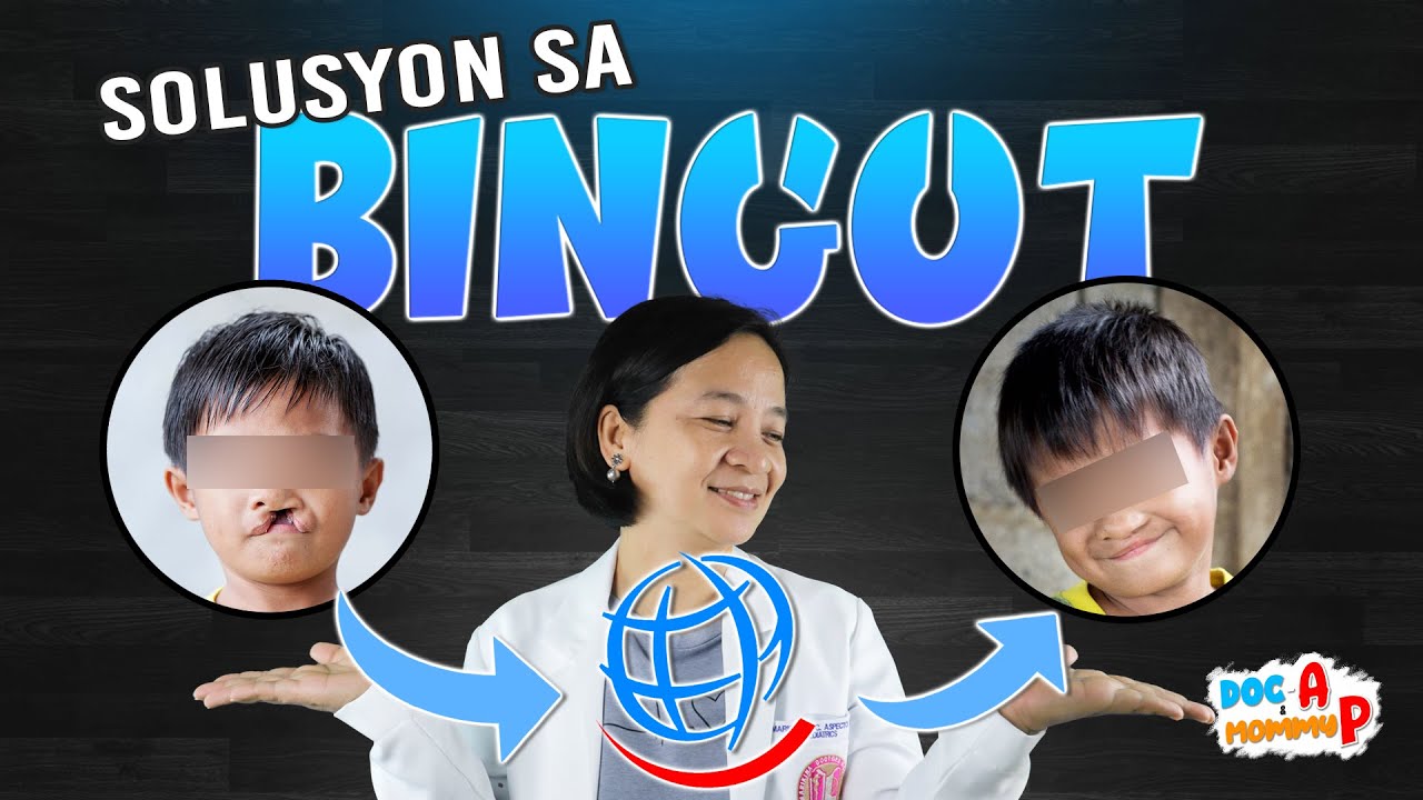Treatment at Gamutan sa BINGOT o Cleft lip & Palate || Operation Smile ...