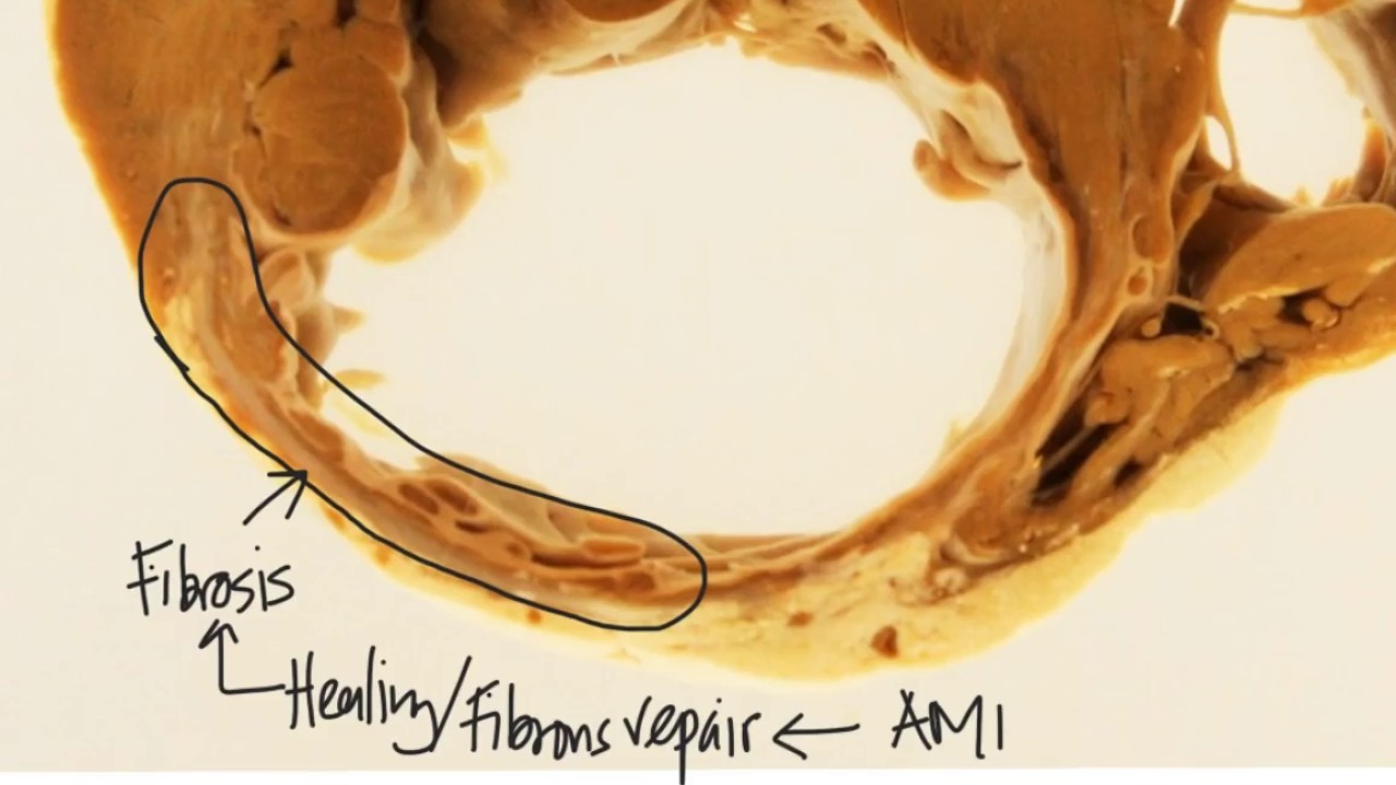 Heart - Healed Myocardial Infarct (Gross and Micro) - YouTube