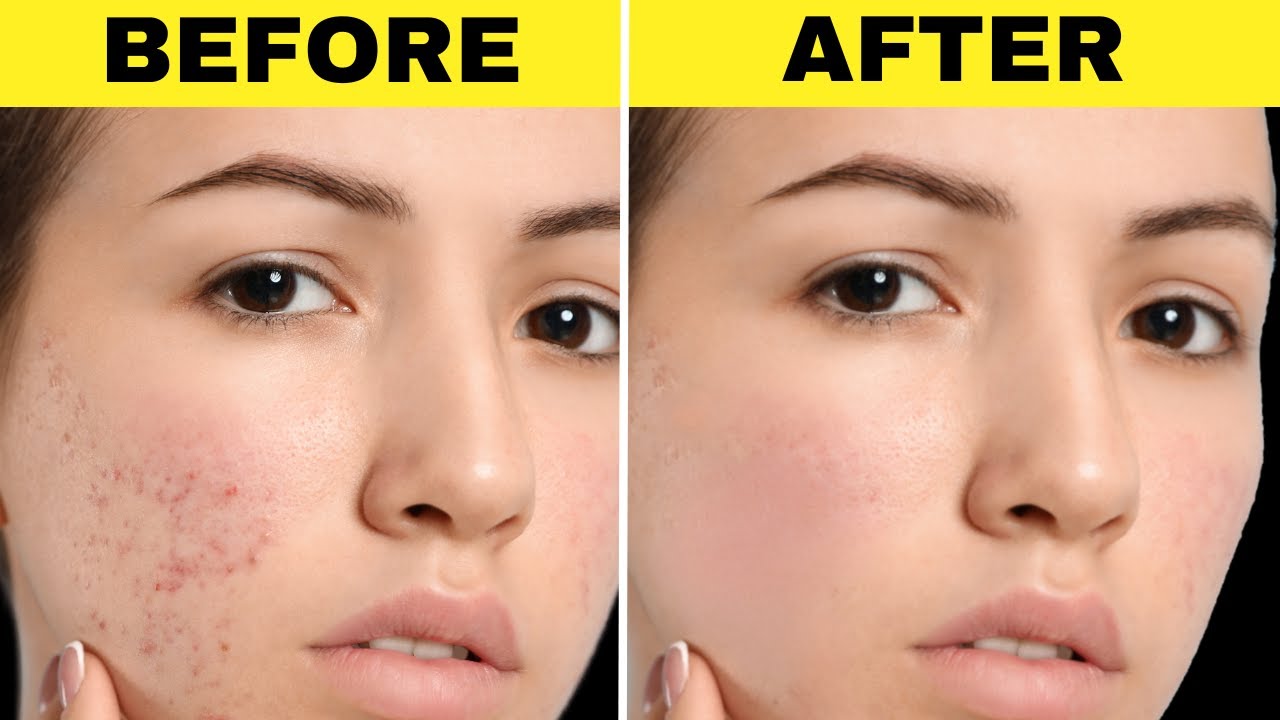 How to Get Rid of Acne Scars: Dermatologists Recommended! | 3 day ...