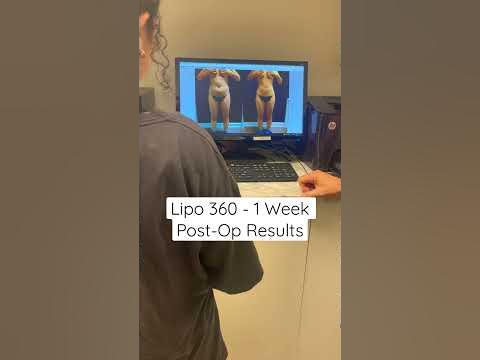 Lipo 360 - 1 Week Post-Op Results - YouTube