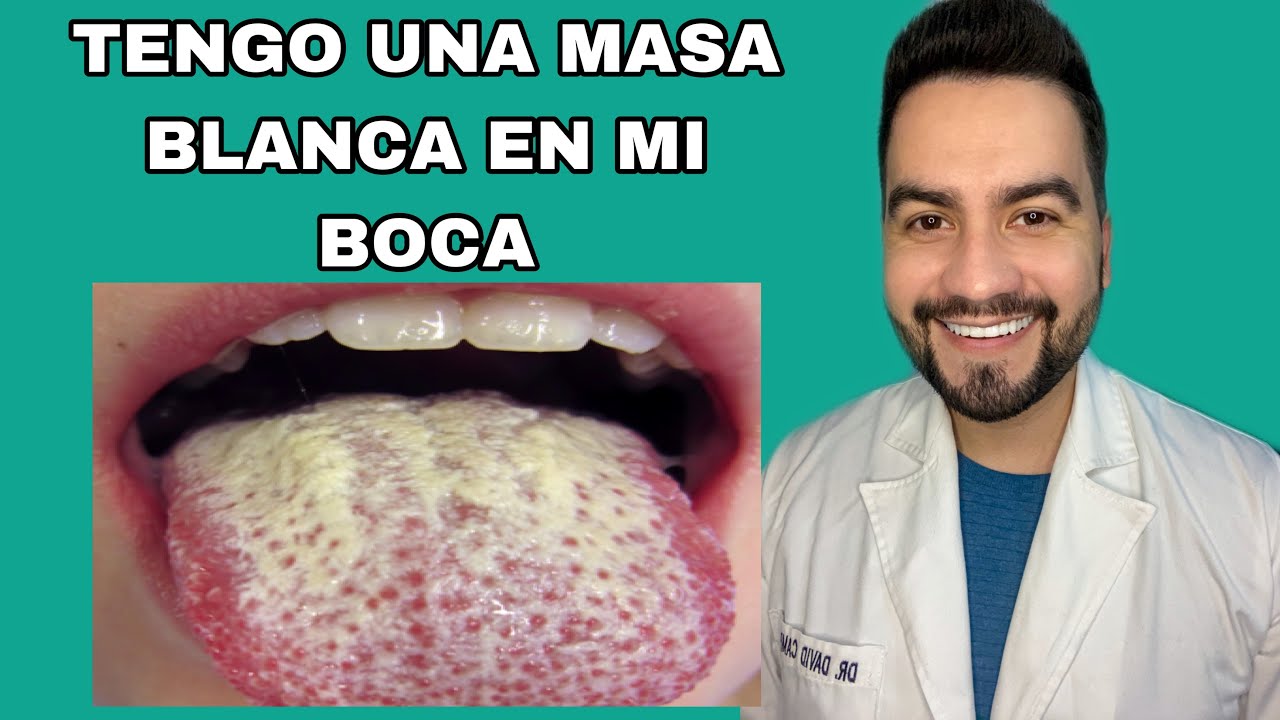 MI LENGUA TIENE UNA MASA BLANCA ESPESA / CANDIDIASIS ORAL | DR. DAVID ...