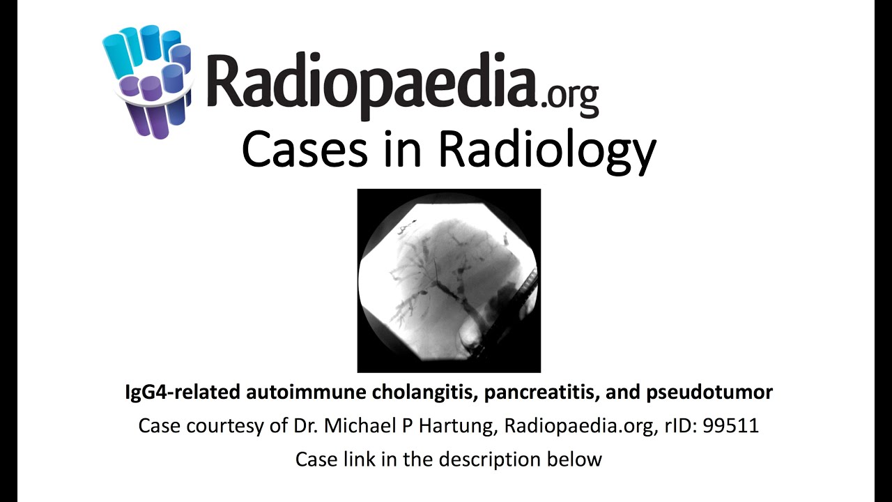 IgG4-related cholangitis (Radiopaedia.org) Cases in Radiology - YouTube