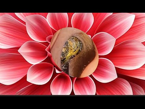 Ear Wax Removal, Dead Skin & Debris Extractio#00084 - YouTube