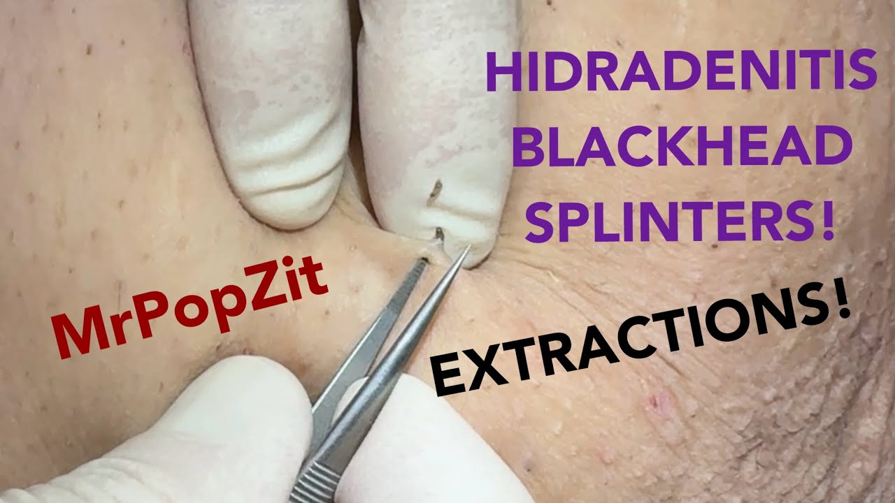 Have you ever seen Splinter Blackheads extracted before!? Check it out ...