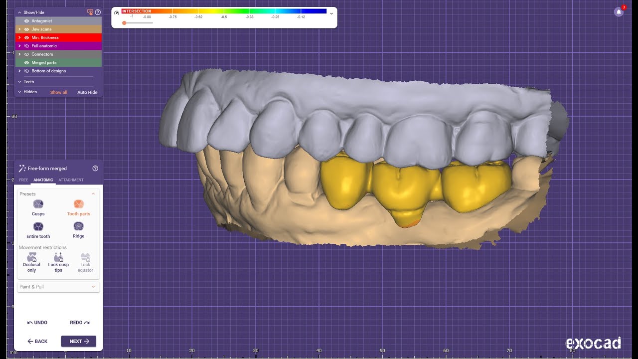 Molars designing for Tooth preparation & single piece implant in exocad ...
