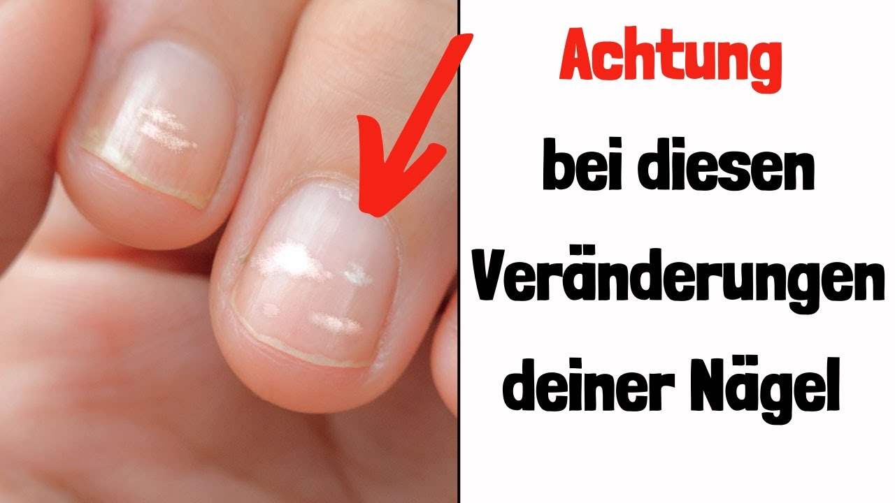 Fingernägel: Was Veränderungen Der Nägel Über Den Körper – XNCUC