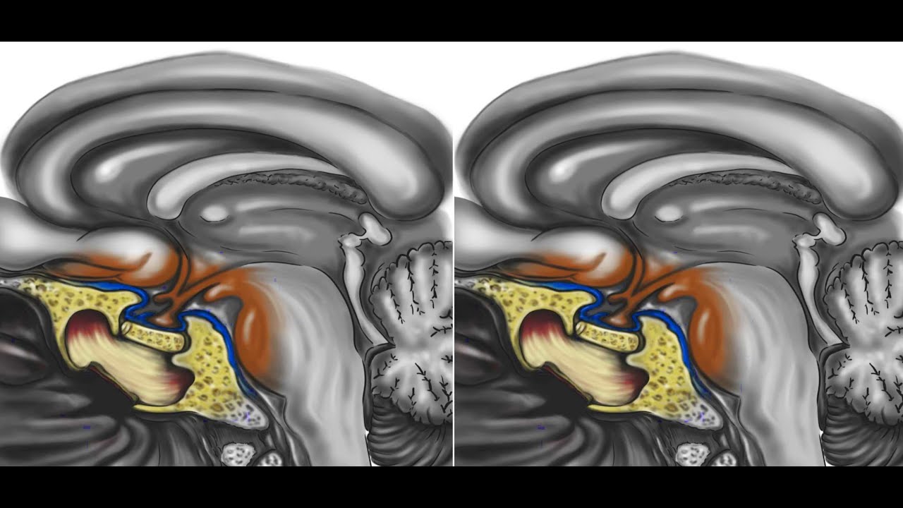Empty Sella Syndrome: Extradural Remodeling (Dr. Alvaro Campero) 3D ...