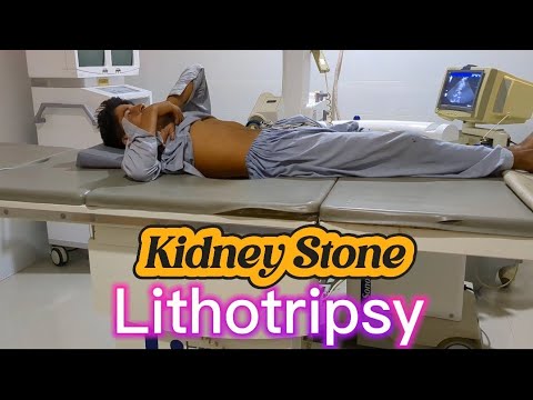 Working of ESWL Lithotripsy | Extracorporeal Shock Wave Lithotripsy ...