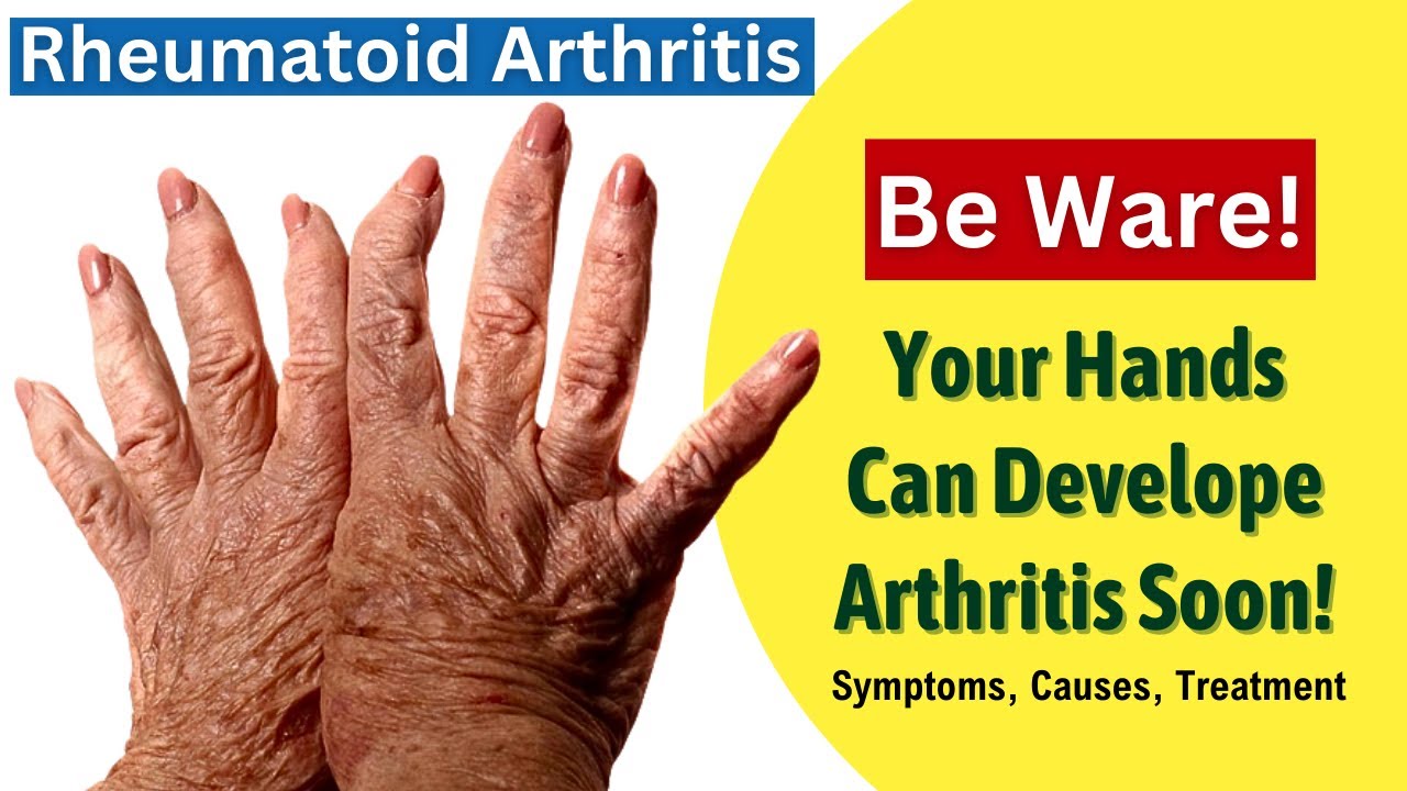 What Is Rheumatoid Arthritis? Triggers, Diagnosis & Treatment With Dr ...