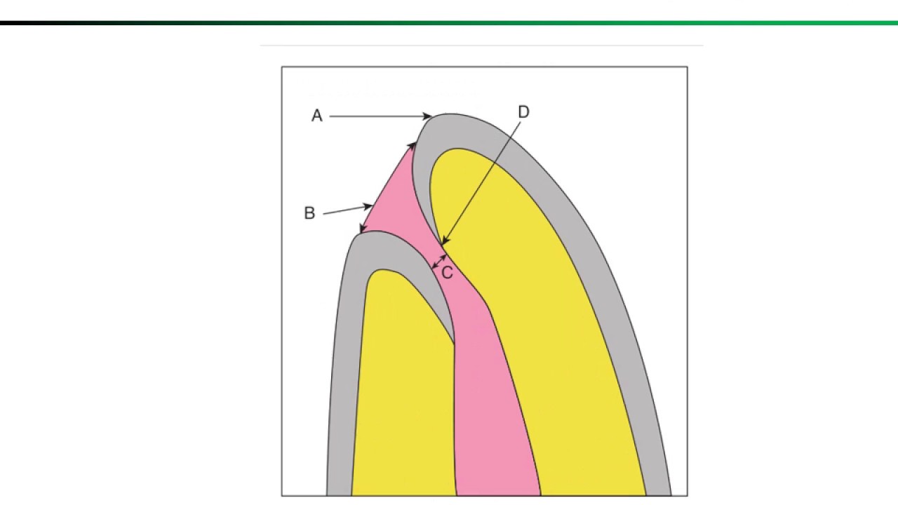 Working length determination : Power Point Slideshow | Dr Benin - YouTube