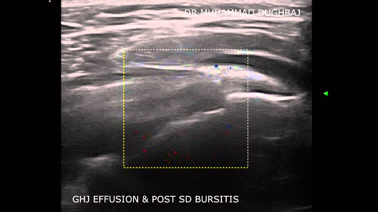 GHJ EFFUSION & POST SD BURSITIS - YouTube