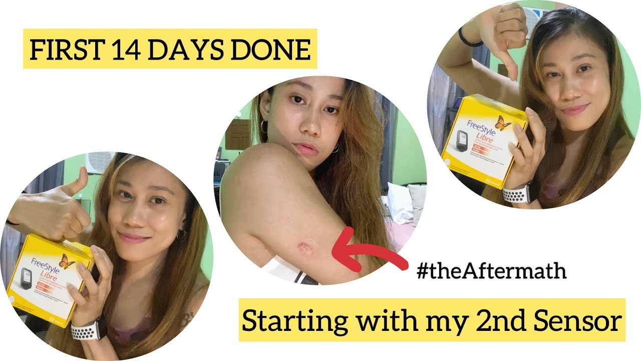 Removing my first Freestyle Libre Sensor - YouTube