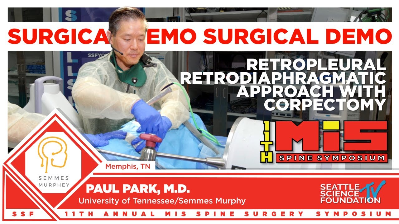 Surgical Demo: Retropleural Retrodiaphragmatic Approach with Corpectomy ...