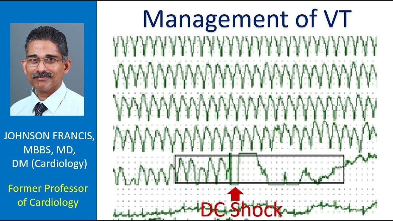 Management of VT - YouTube