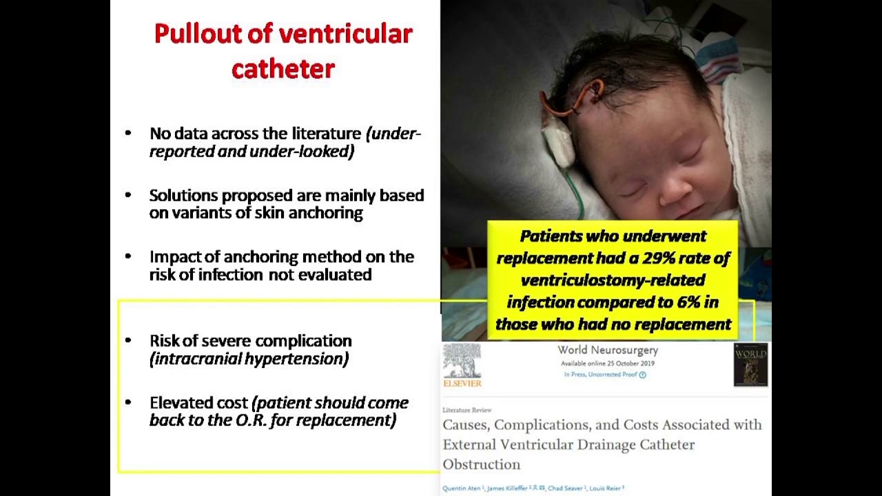Securacath in Neurosurgery Frassanito - YouTube