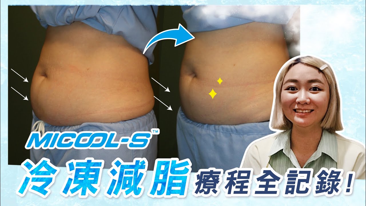 【素人案例】MICOOL-S冷凍減脂療程體驗！躺著就能減脂？！真的那麼神？！ - YouTube