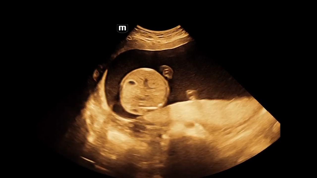 Achondroplasia Rhizomelic Dwarfism Fetal Ultrasound Youtube