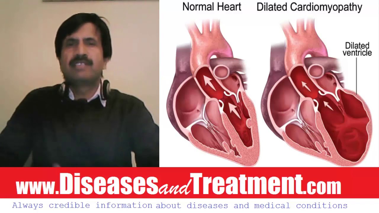 46# Dilated cardiomyopathy Causes, Diagnosis, Symptoms, Treatment ...