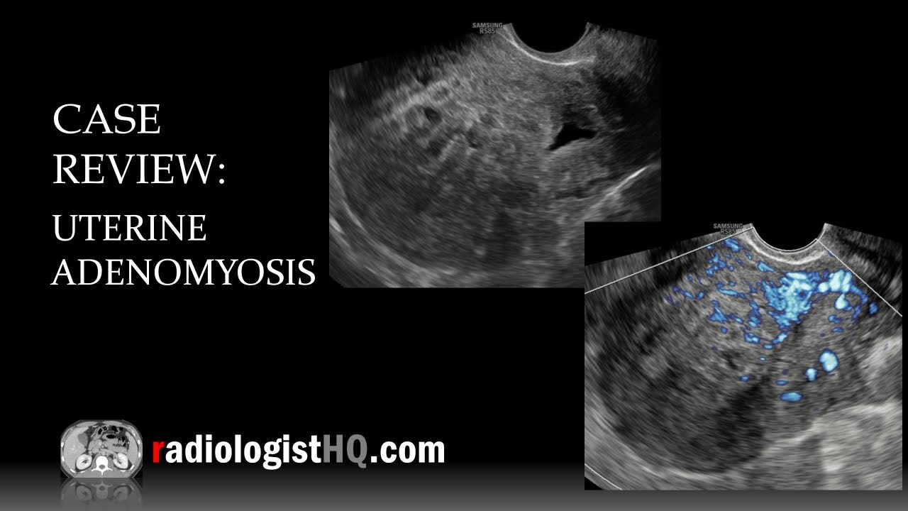Case Review Ultrasound Of Uterine Adenomyosis Youtube