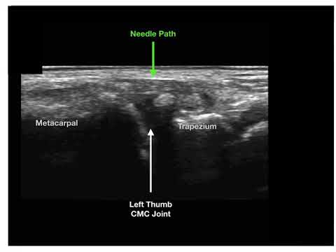 PRP Injection off thumb arthritis with ultrasound guidance - YouTube